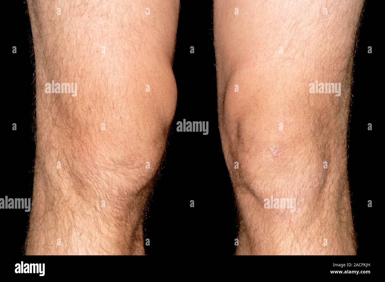 Injured knee. 39 year old man's swollen knee (seen at left) caused by a ...