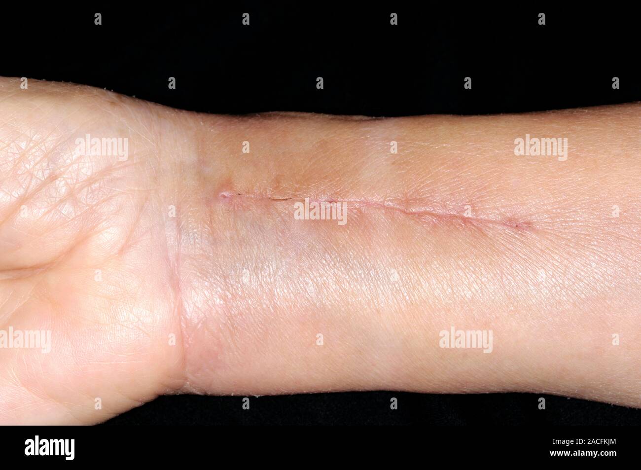 Fracture repair scar on the wrist of a 73 year old woman. This scar is ...