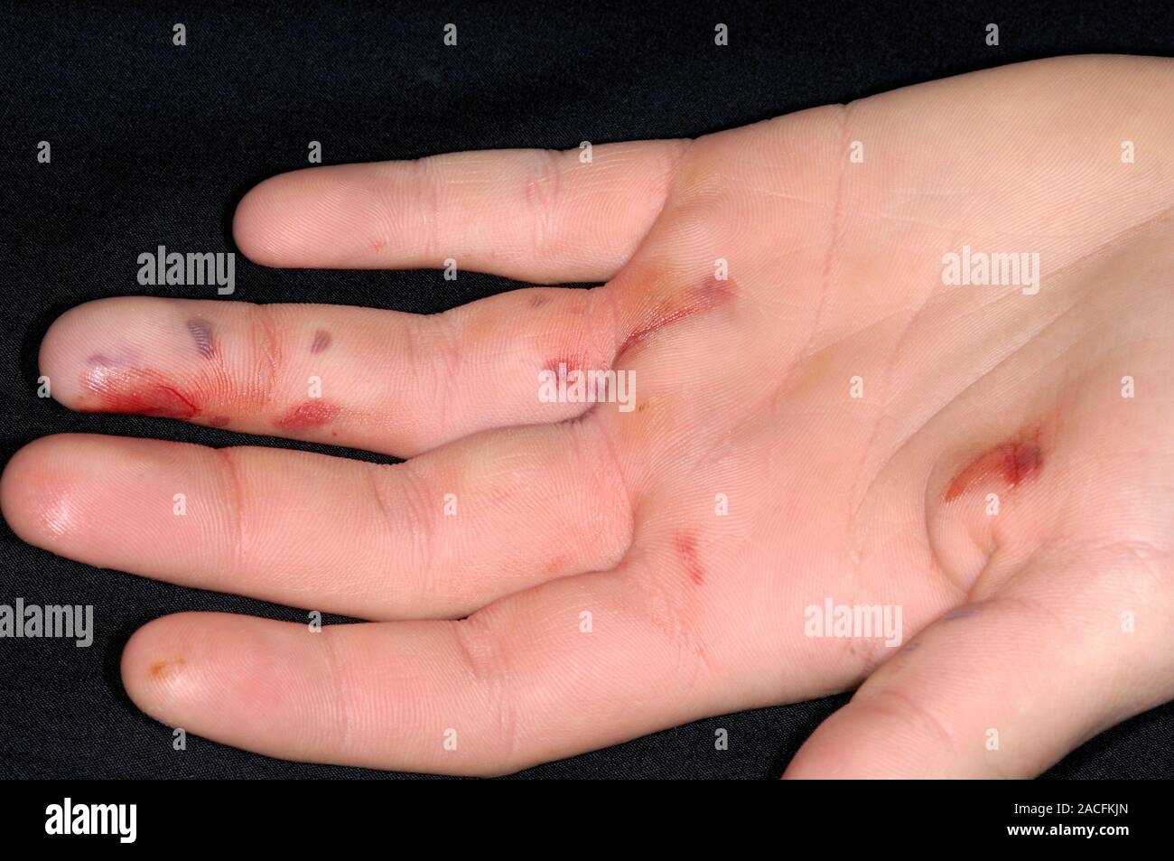 Firework injuries. Superficial burns on a 17 year old boy's palm caused ...