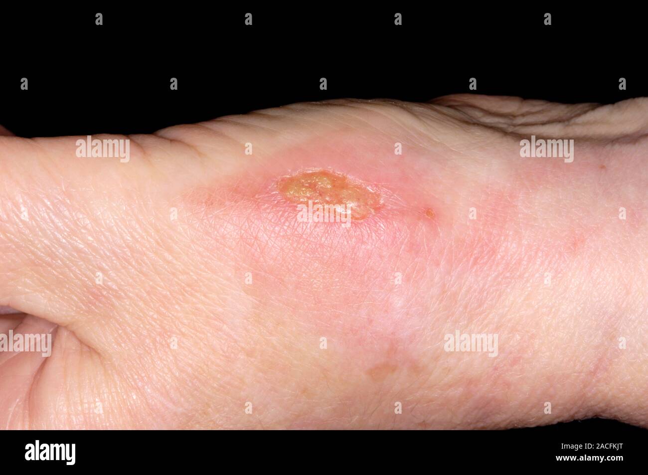 Infected burn on a 73 year old woman's hand. The red area is a sign of ...