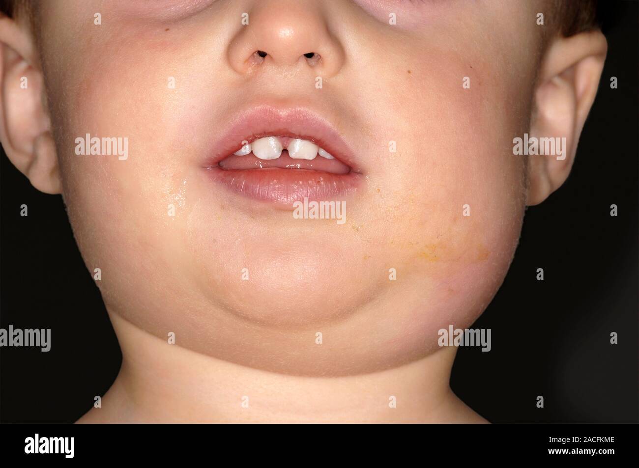 Mumps. Swollen gland (right) of a 2 year old boy with mumps parotitis ...