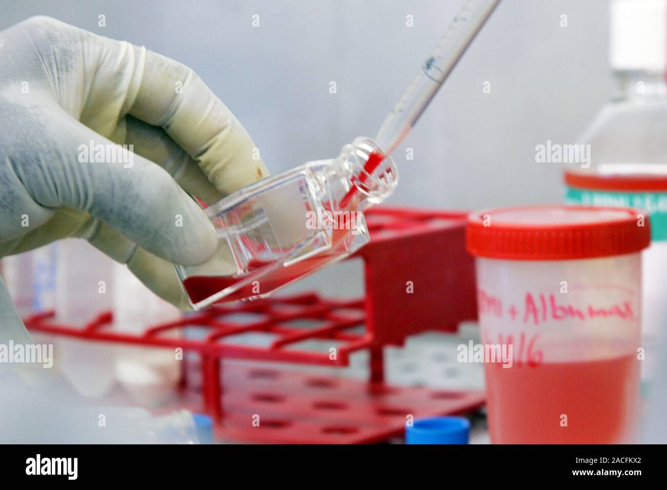 Malaria research, Africa. Researcher pipetting a culture of the malaria ...