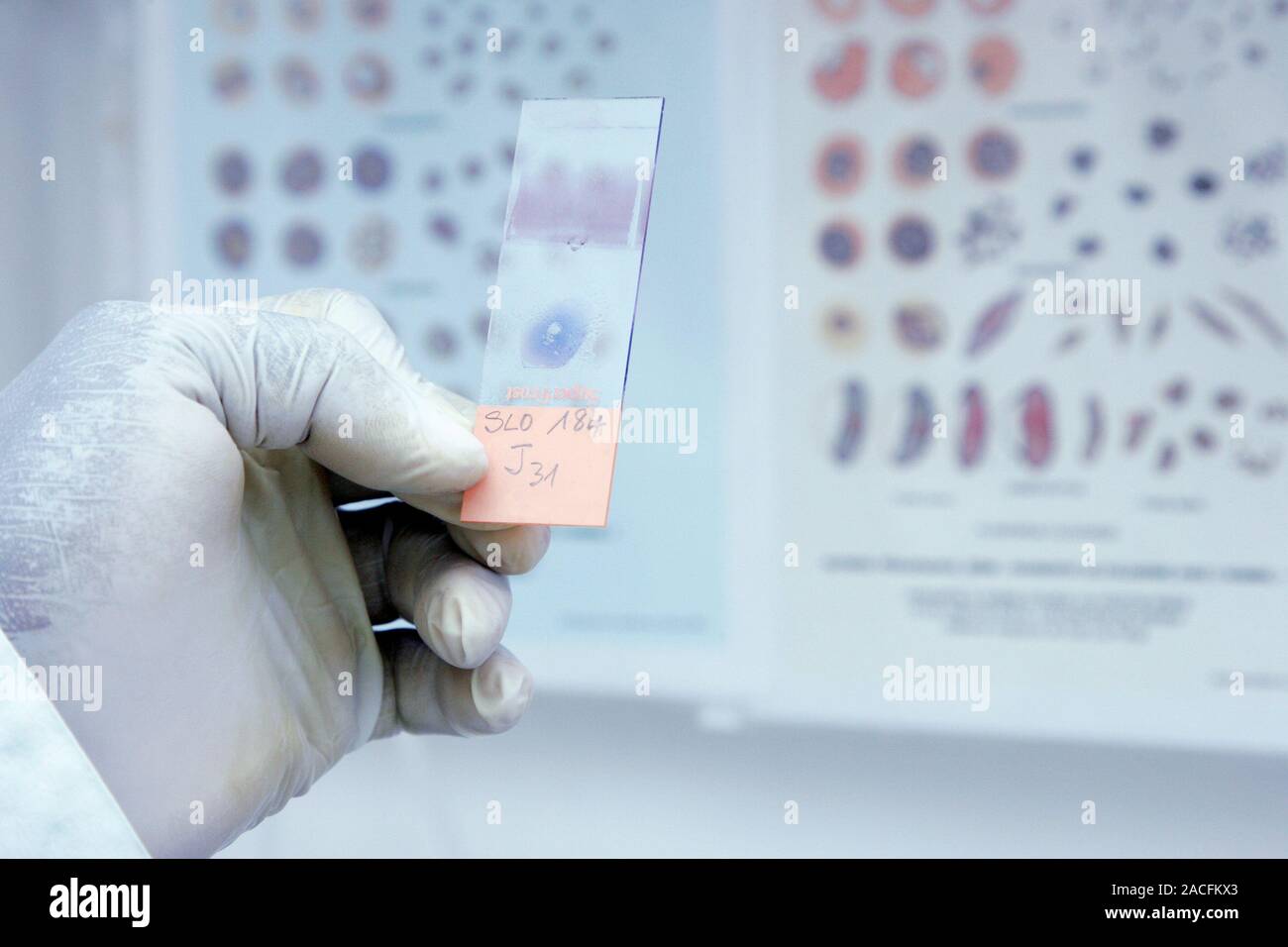 Malaria research, Africa. Researcher holding a glass slide with a smear ...