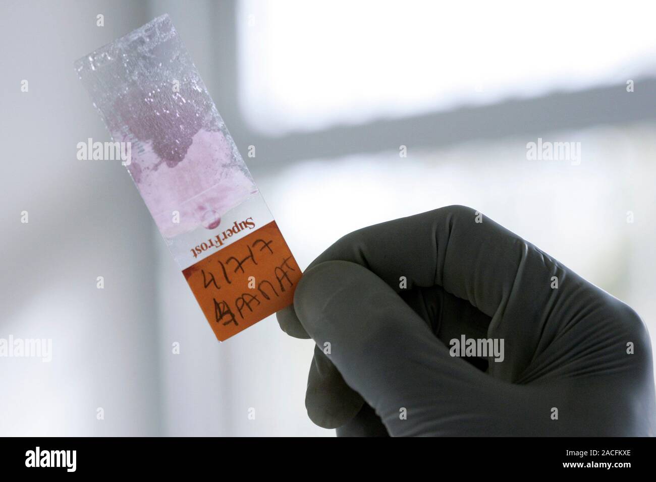Malaria research, Africa. Researcher holding a glass slide with a smear ...
