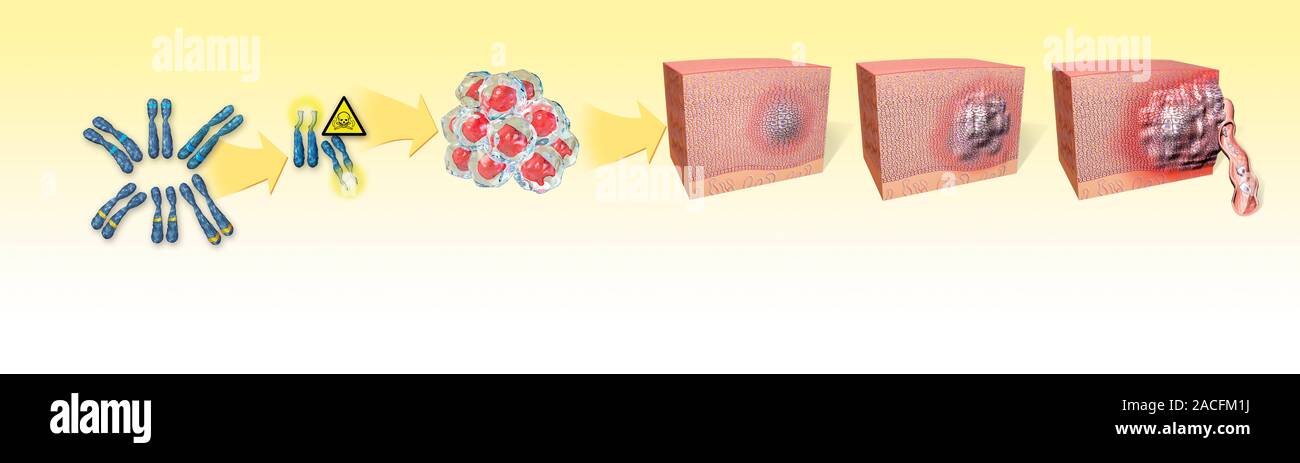 Genetic mutations and cancer. Artwork showing the genetic basis of the ...