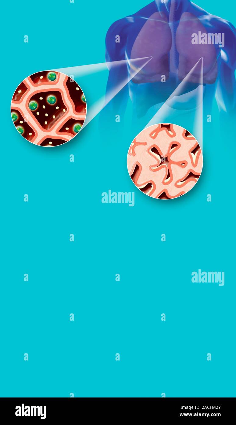 Asthma and mucus overproduction. Artwork showing how the body's immune ...