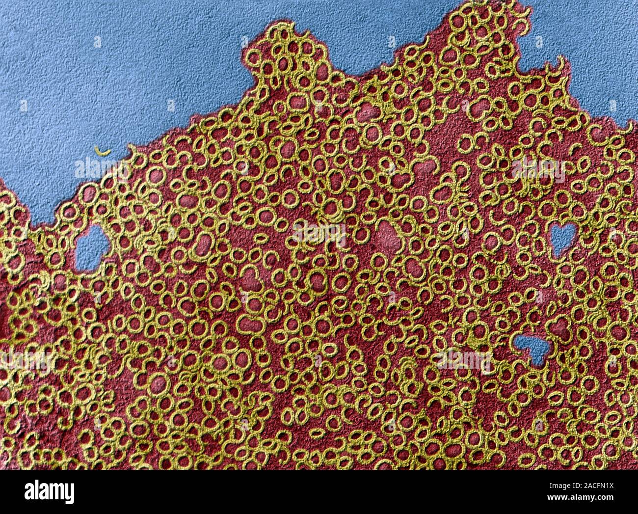 Red blood cell destruction. Coloured transmission electron micrograph ...