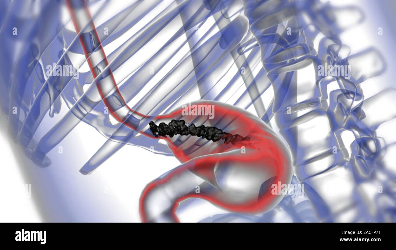 Stomach, X-ray artwork. The stomach (lower centre) is the organ that ...