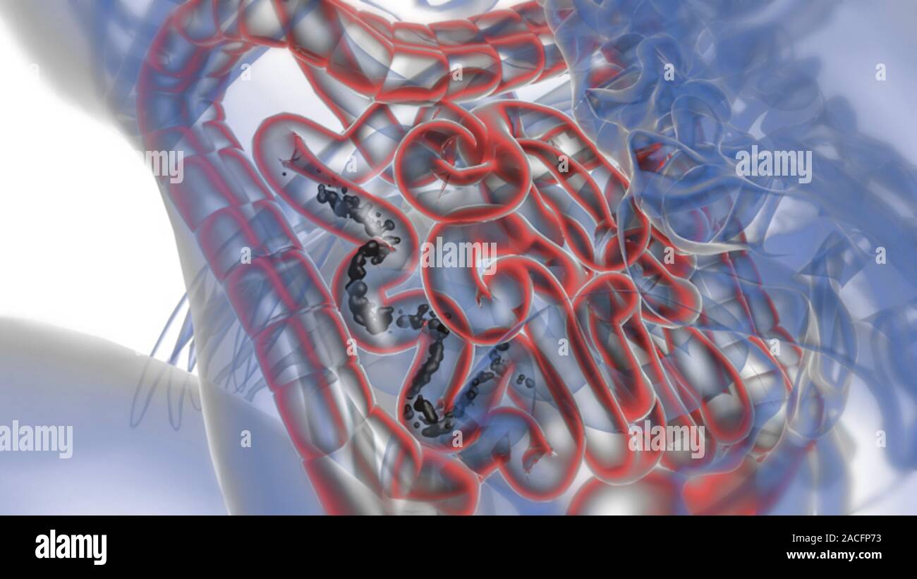 Intestines, X-ray artwork. The intestines receive semi-digested food ...
