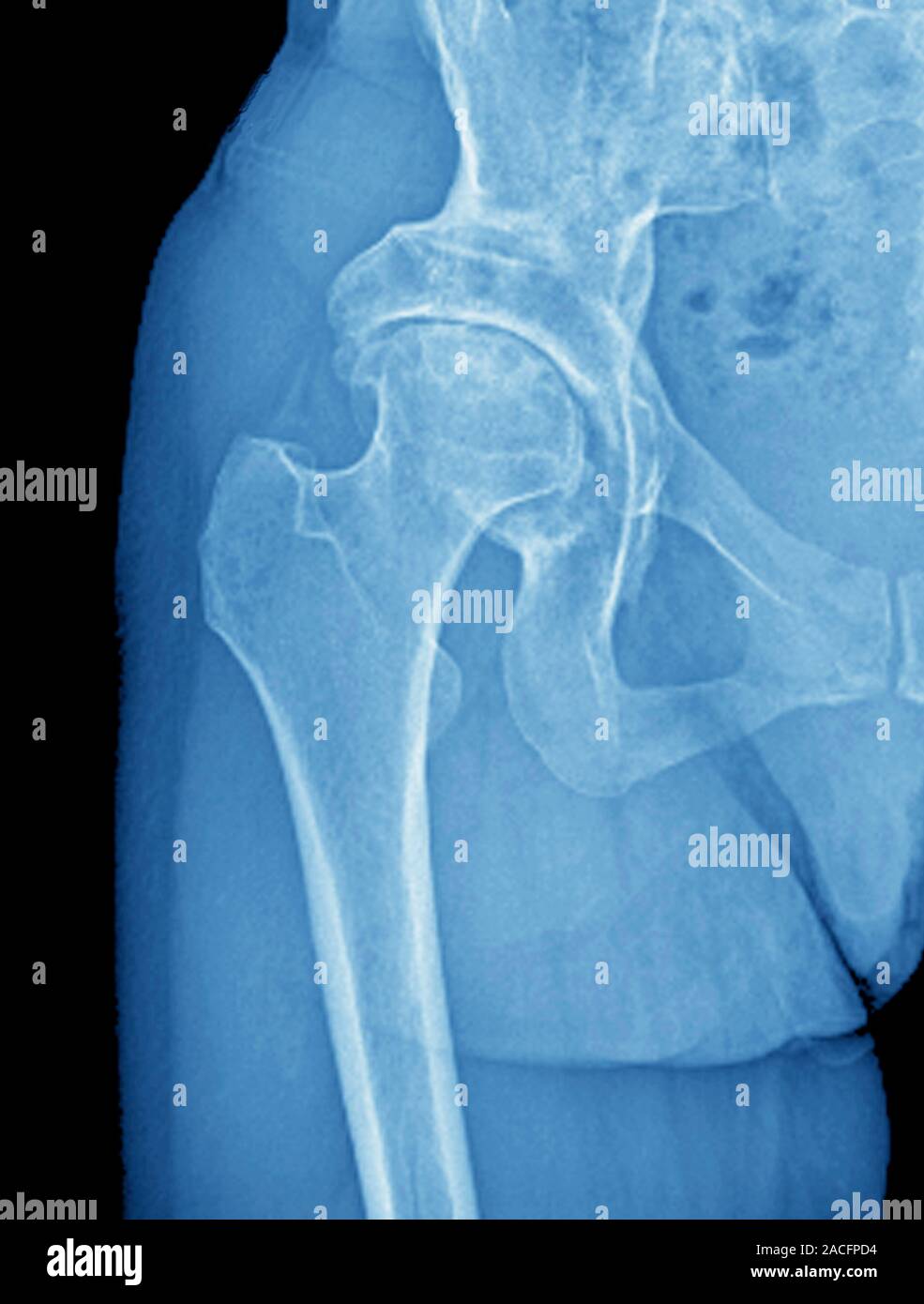 Coloured X-ray of the hip of a patient aged 54 showing osteoarthritis ...