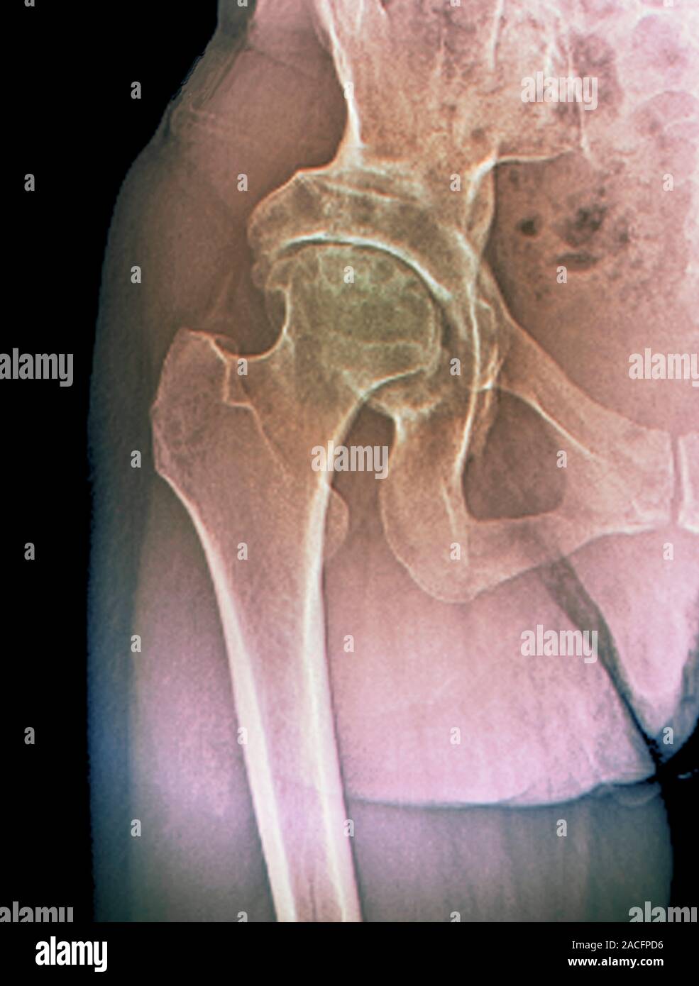 Coloured X-ray of the hip of a patient aged 54 showing osteoarthritis ...