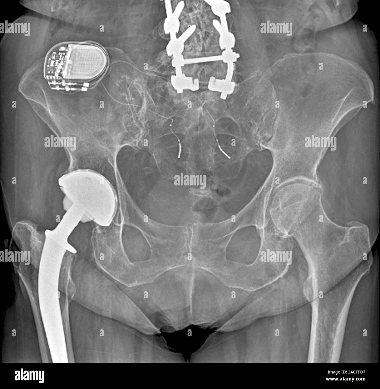 X-ray of the pelvis of a patient aged 80 showing an implant device ...