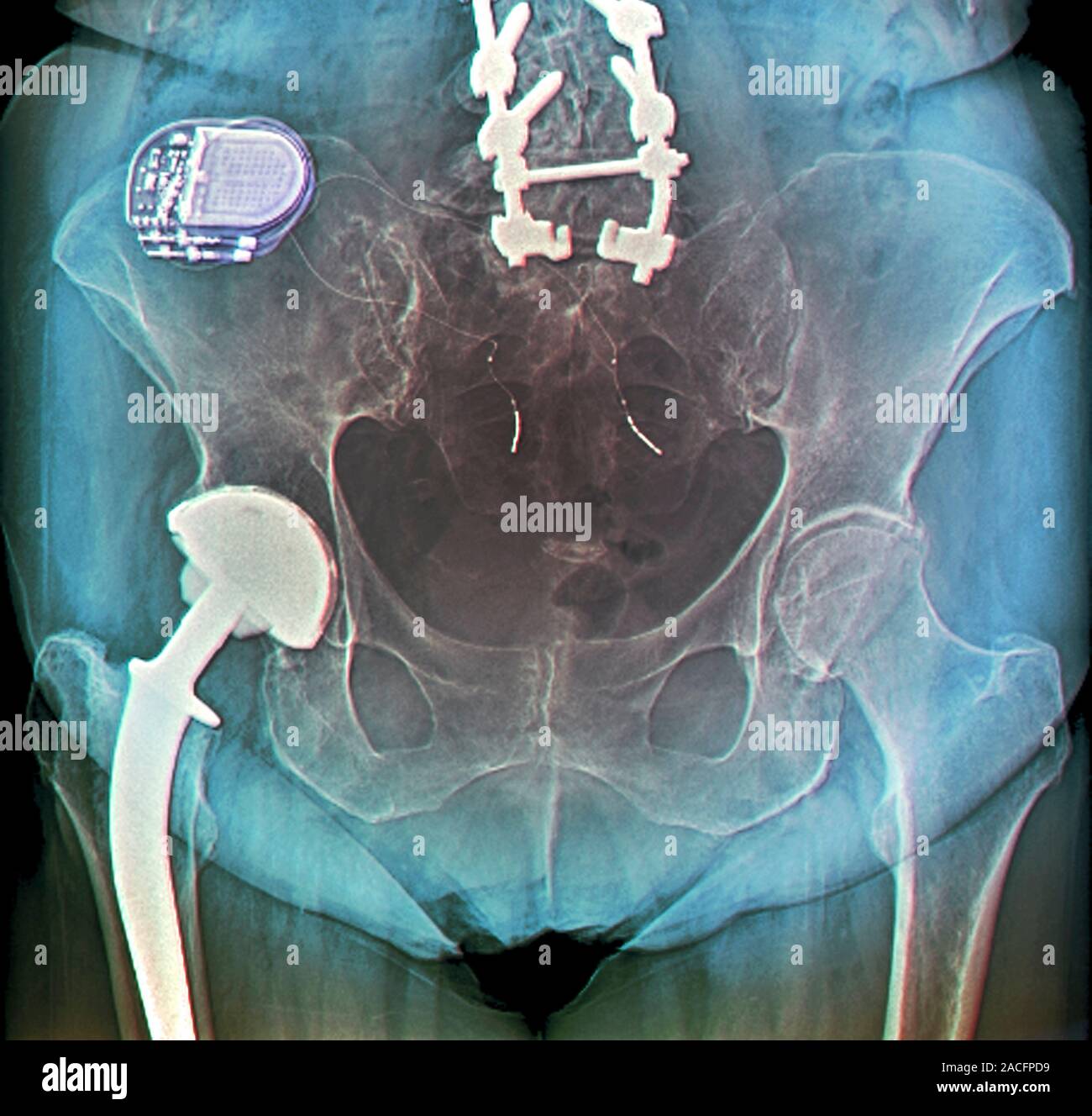 Coloured X-ray of the pelvis of a patient aged 80 showing an implant ...