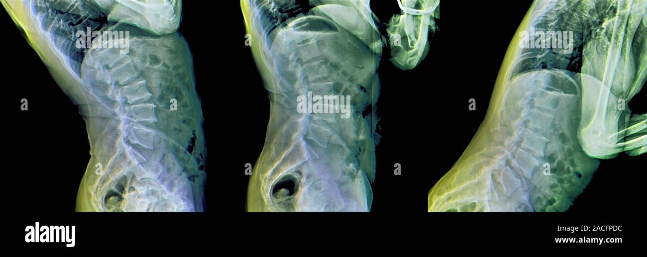 Coloured x-rays of the side view of a patient aged 60 showing the ...