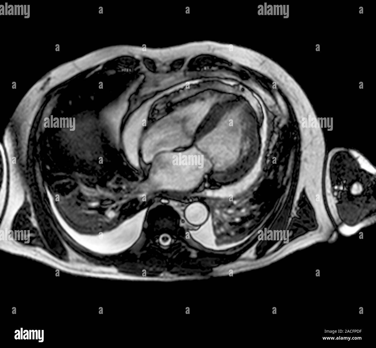MRI scan of an axial (horizontal) section through the chest of a ...