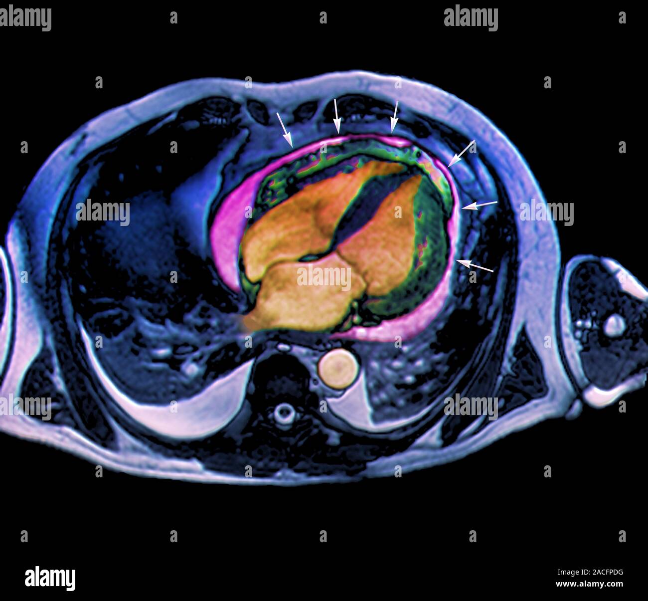Coloured MRI scan of an axial (horizontal) section through the chest of ...