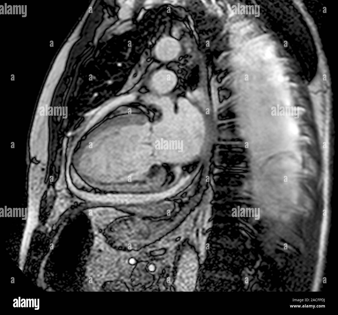 MRI scan of a sagittal (longitudinal) section through the chest of a ...