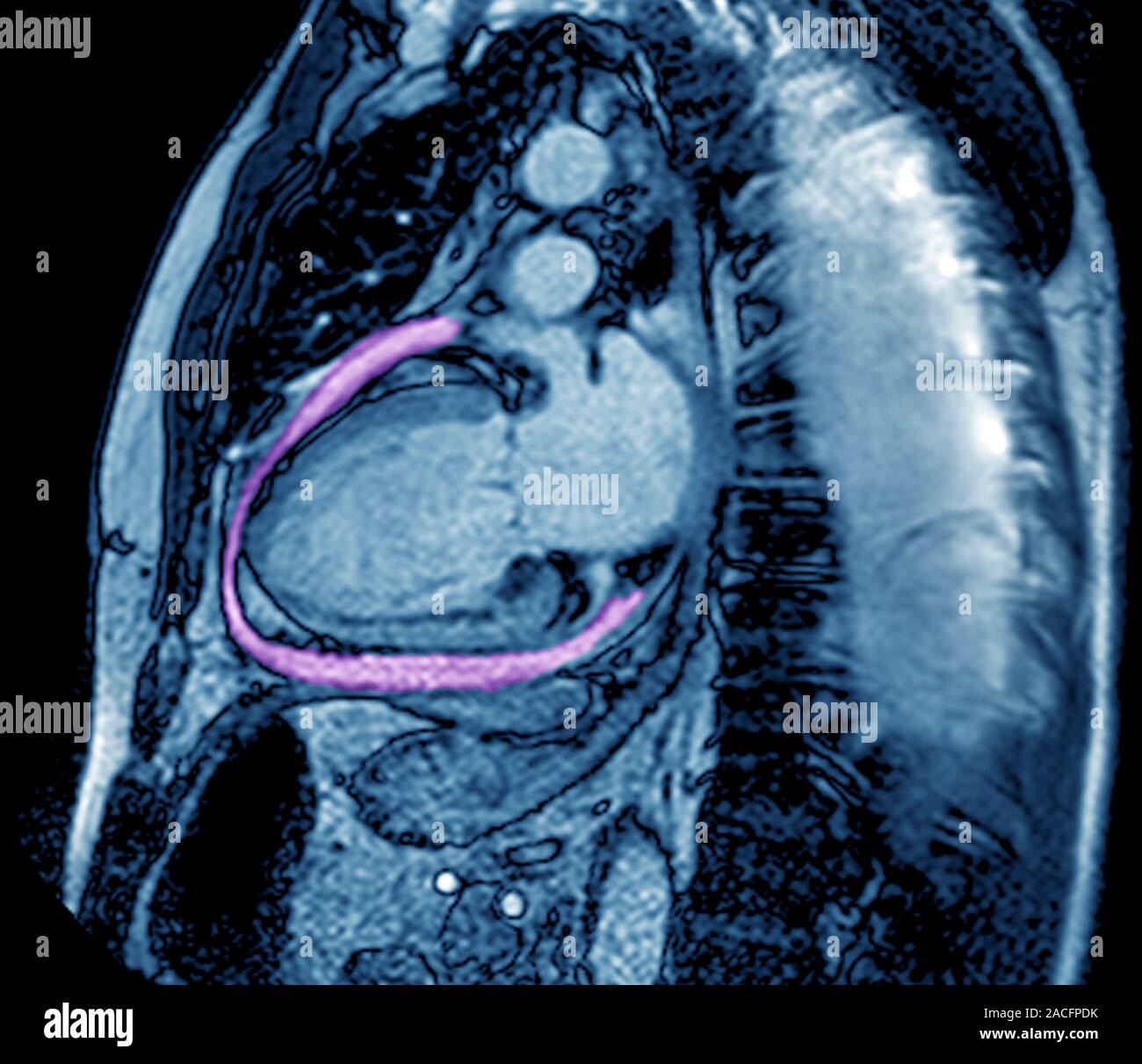 Coloured MRI scan of a sagittal (longitudinal) section through the ...