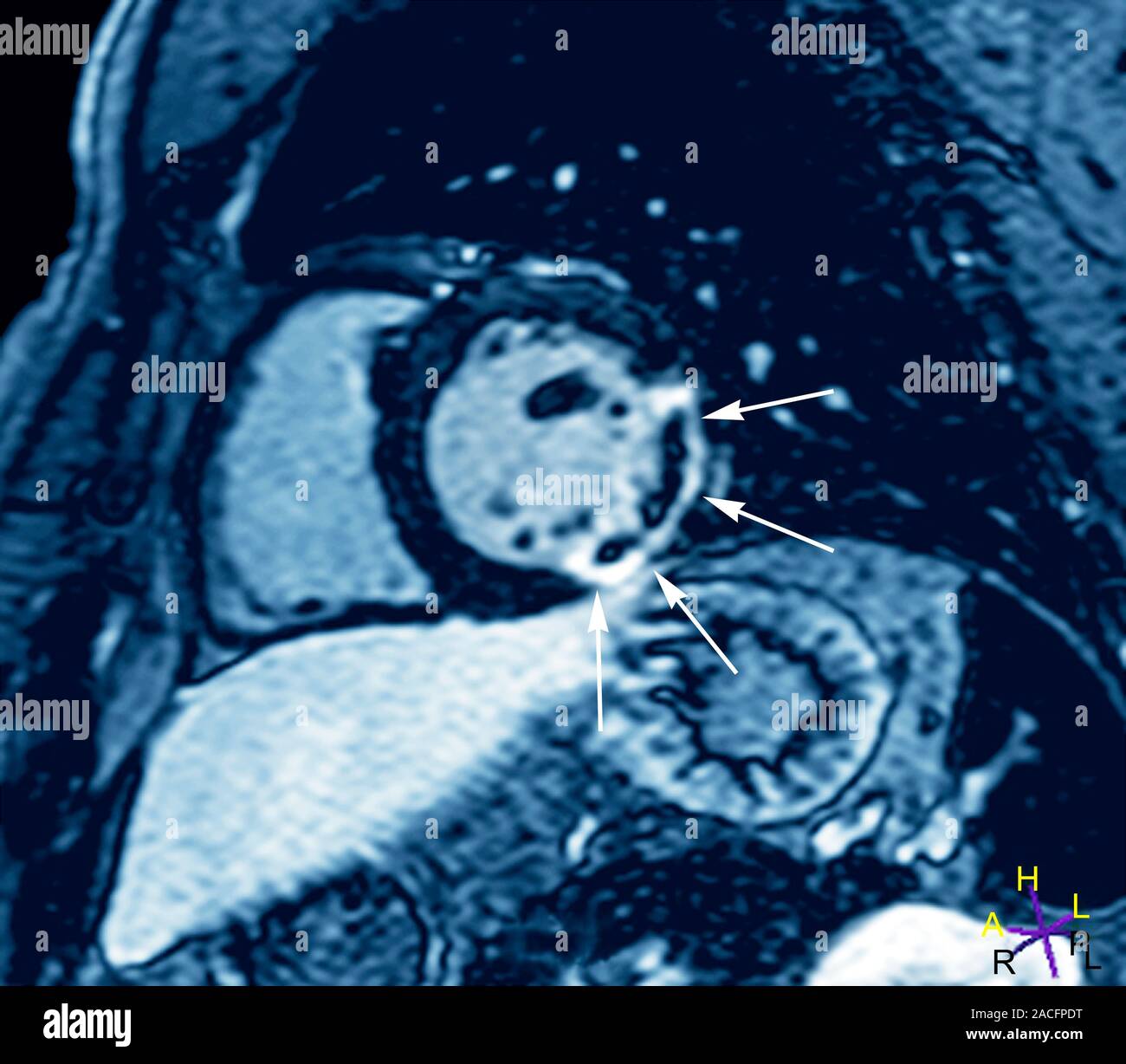 Coloured MRI scan of a section through the chest and heart of a patient ...