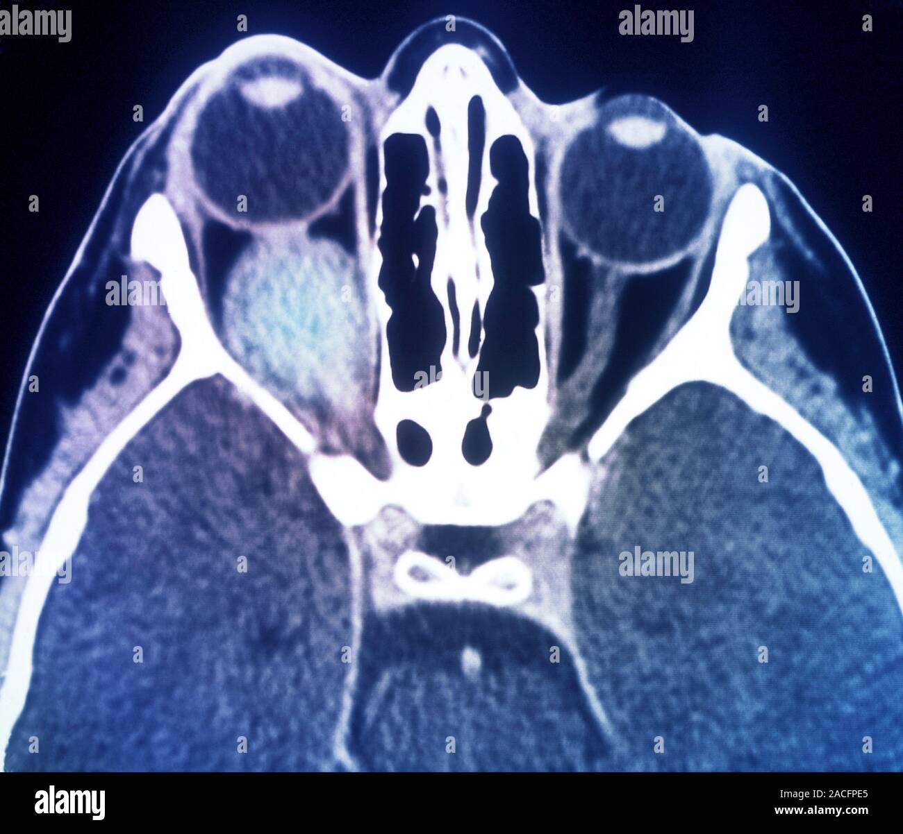 Coloured computed tomography (CT) scan of an axial section through the ...