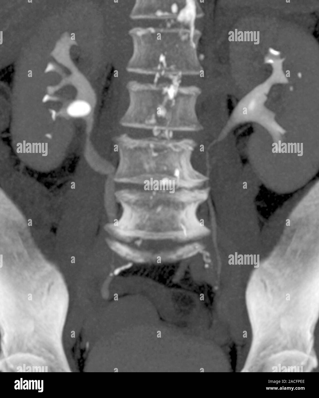 Computed tomography (CT) scan of the abdomen of a patient aged 66 ...