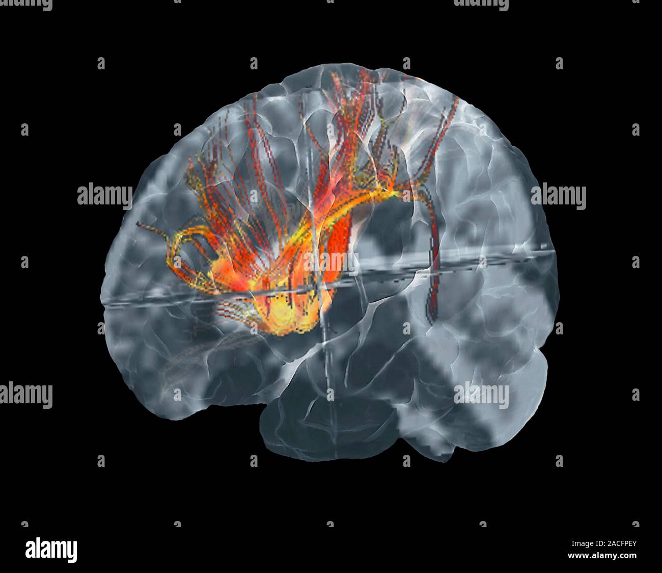 3-D Coloured Tractography Magnetic Resonance Imaging (MRI) brain scan ...