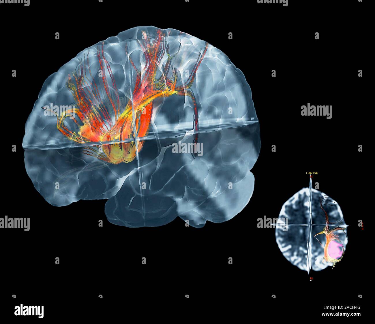 3-D Coloured Tractography Magnetic Resonance Imaging (MRI) brain scan of a patient aged 36 with ...