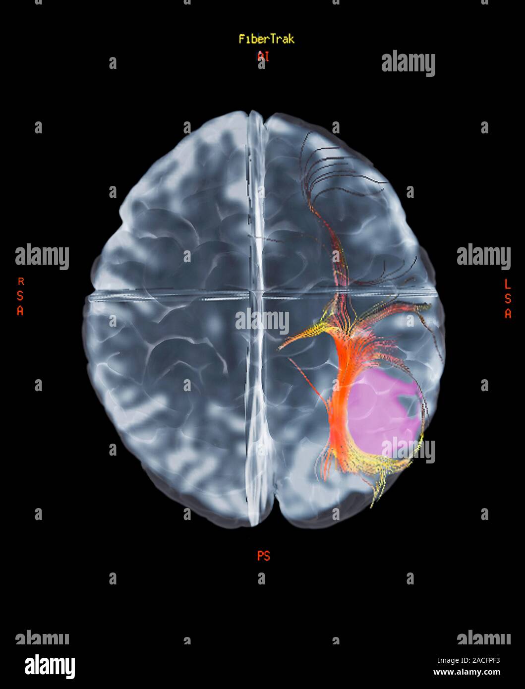 3-D Coloured Tractography Magnetic Resonance Imaging (MRI) brain scan of a patient aged 36 with ...