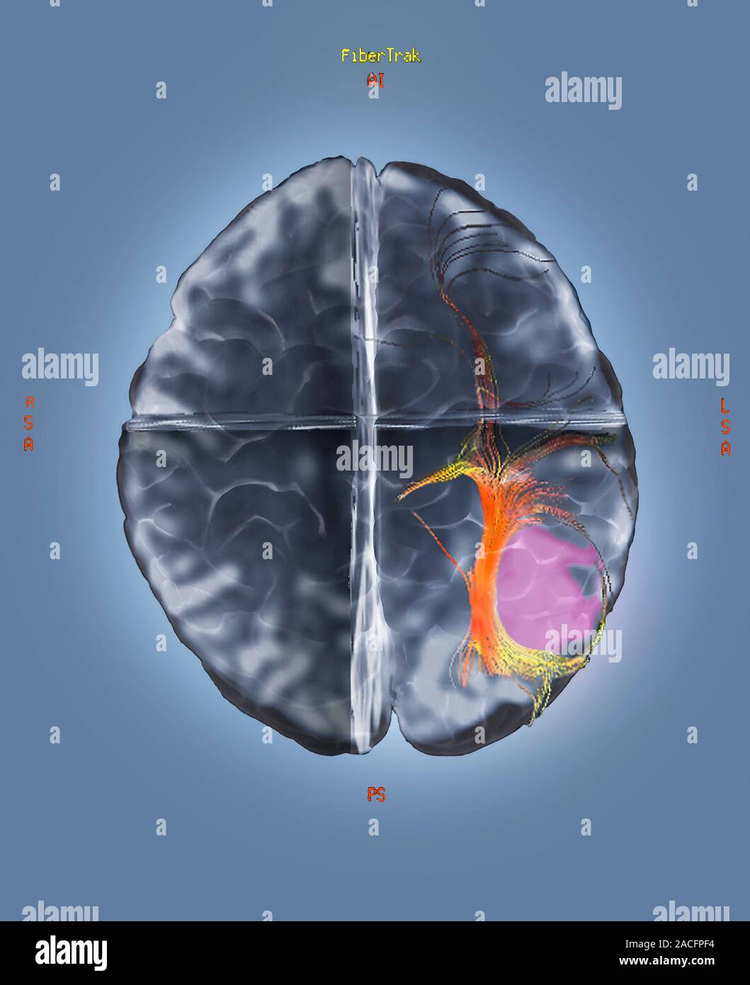 3-D Coloured Tractography Magnetic Resonance Imaging (MRI) brain scan of a patient aged 36 with ...