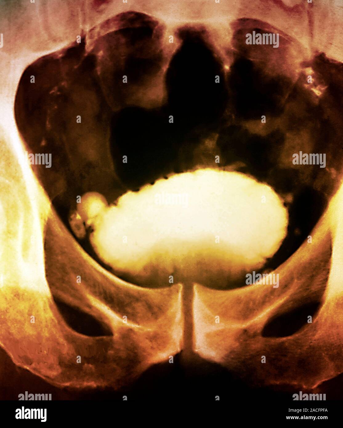 Coloured urogram (X-ray) of the pelvis of a male patient aged 62 ...