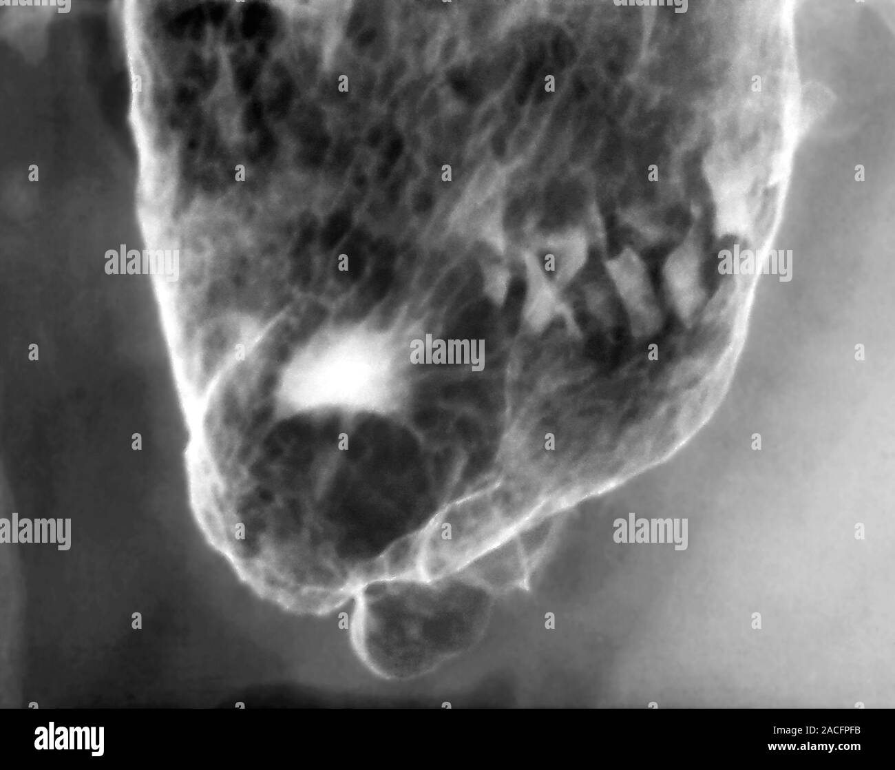 Barium swallow X-ray of the stomach of a patient aged 49, showing a ...