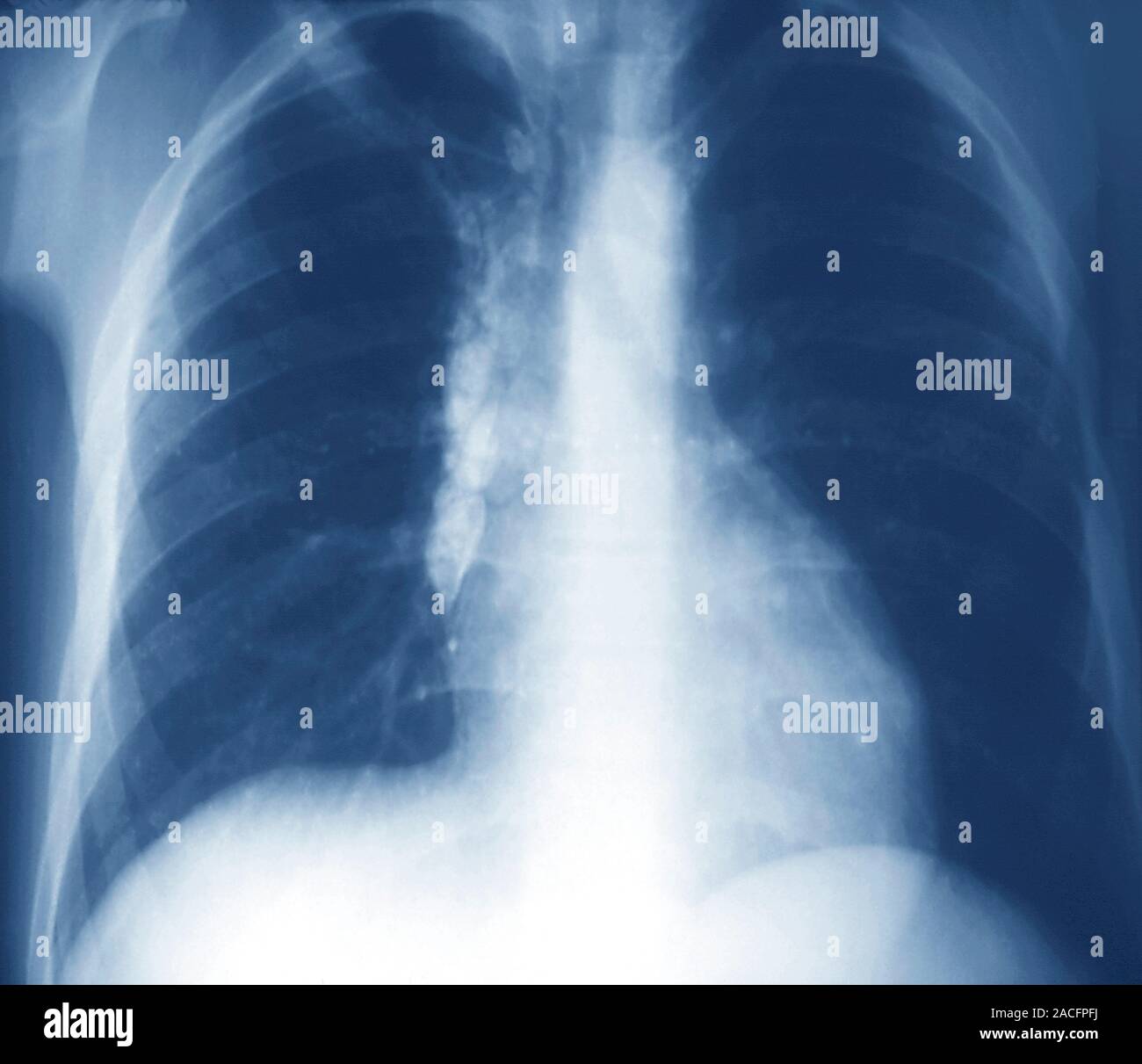 Coloured lymphography (X-ray) of the chest of a patient showing ...