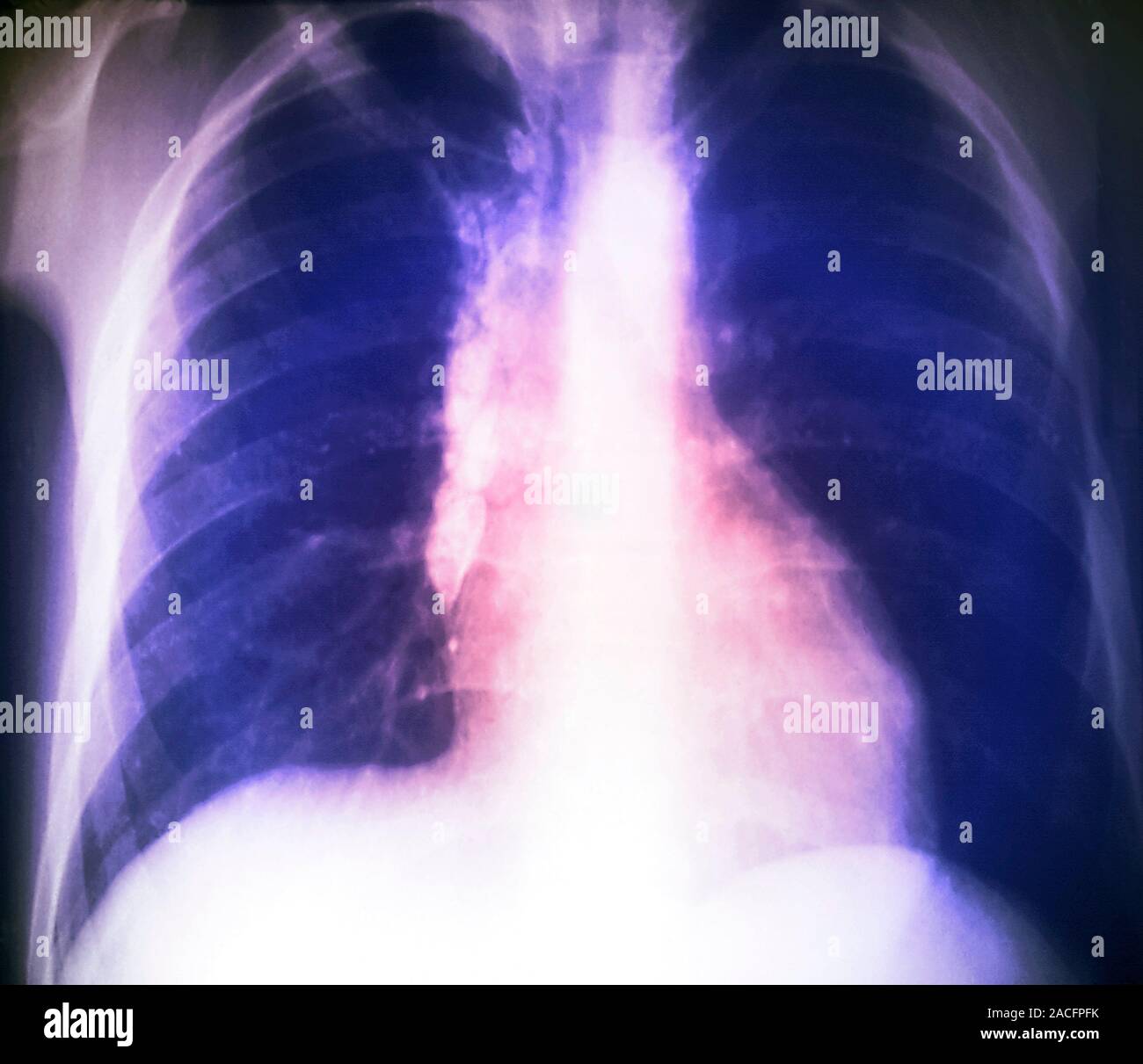 Coloured lymphography (X-ray) of the chest of a patient showing ...