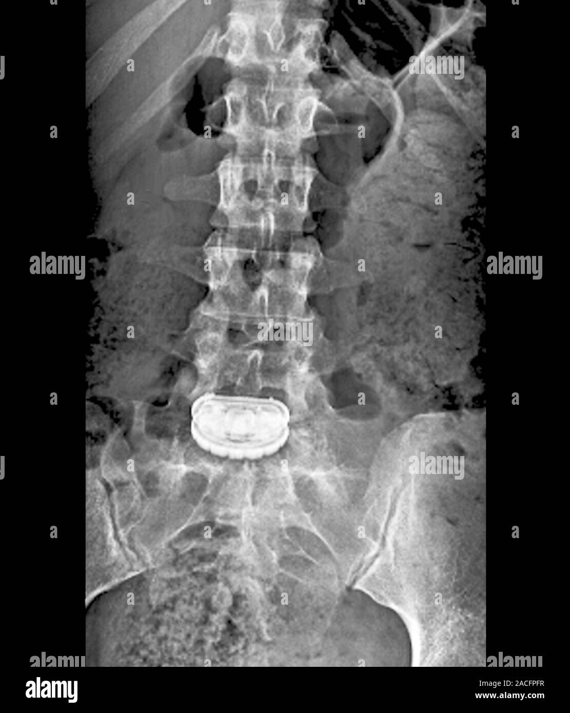 X-ray (front view) of the spine of a patient aged 35, showing an ...