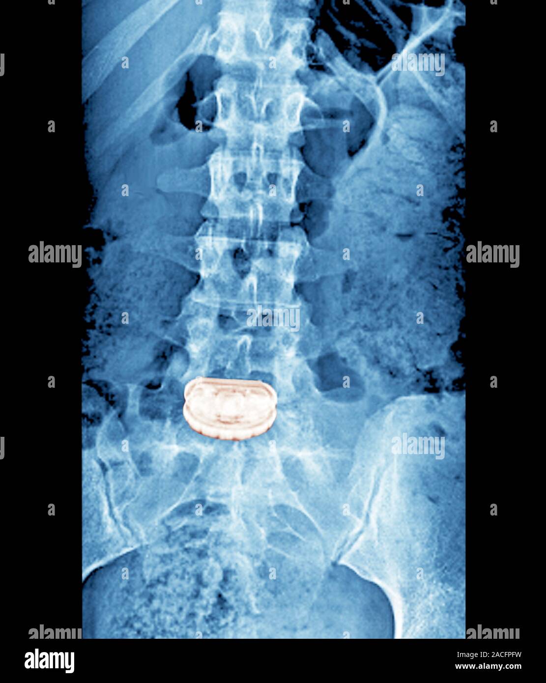 Coloured X-ray (front view) of the spine of a patient aged 35, showing ...