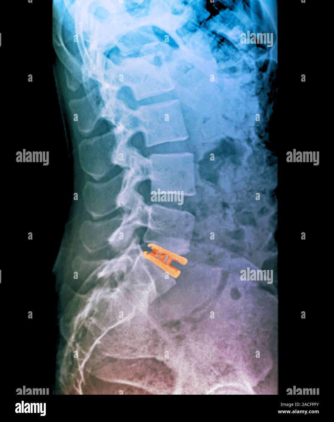 Coloured X-ray (side view) of the spine of a patient aged 35, showing ...