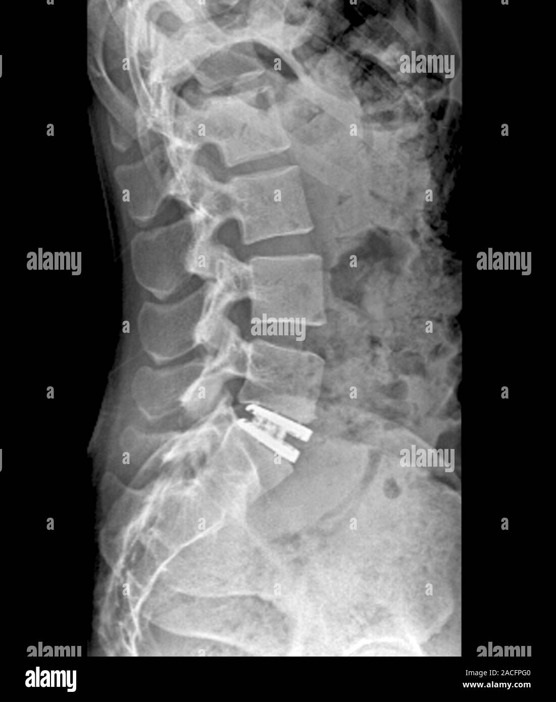 X-ray (side view) of the spine of a patient aged 35, showing an ...