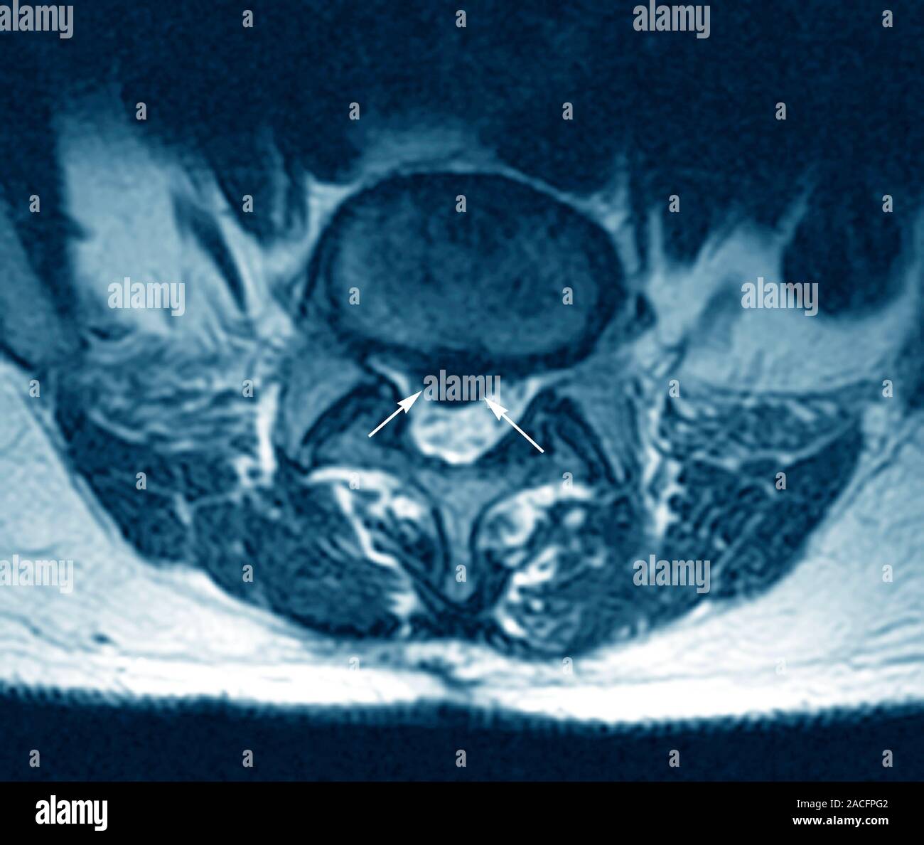Magnetic resonance imaging (MRI) scan of an axial (horizontal) view of ...