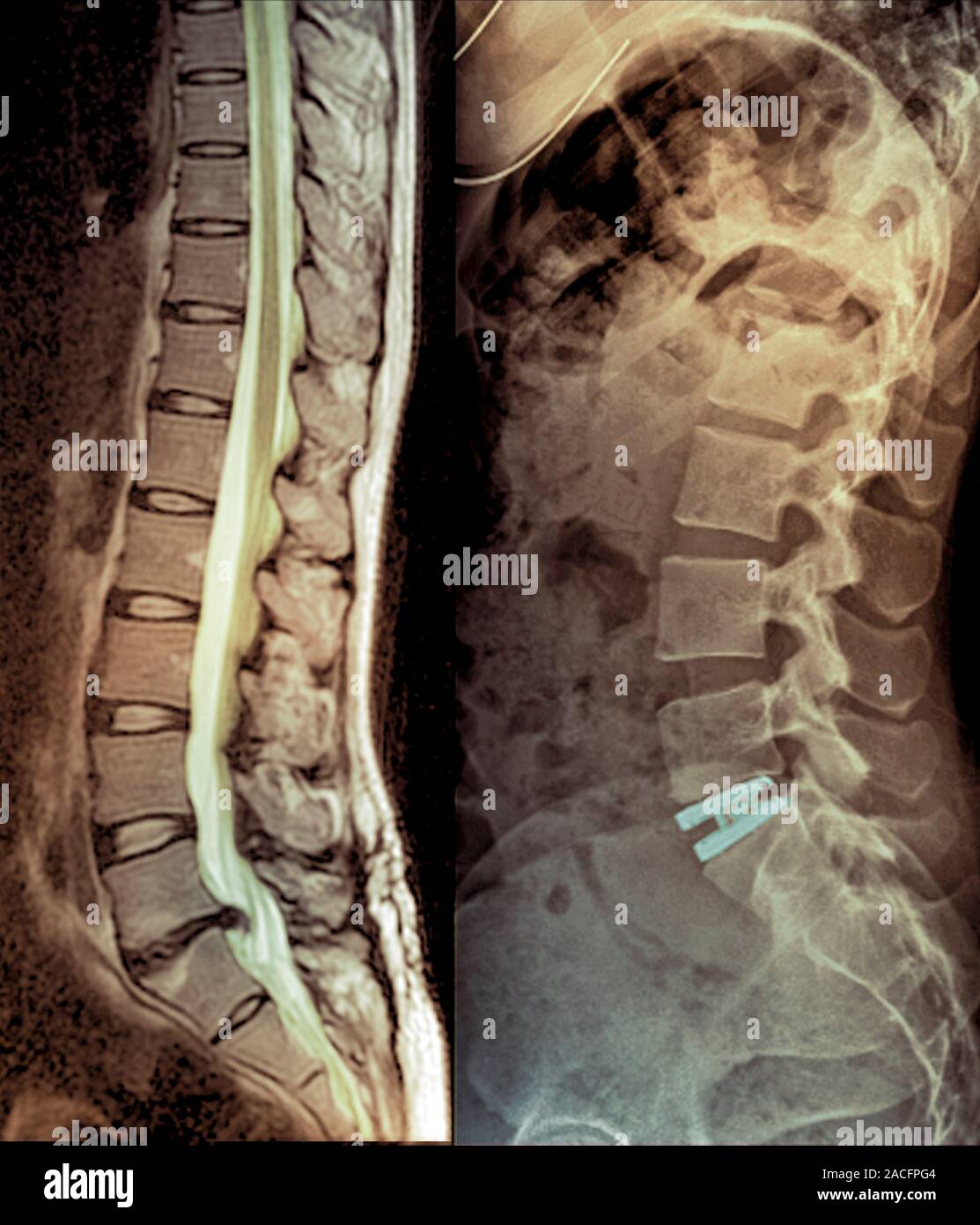 Coloured Magnetic Resonance Imaging (MRI) scan at left, and X-ray at ...