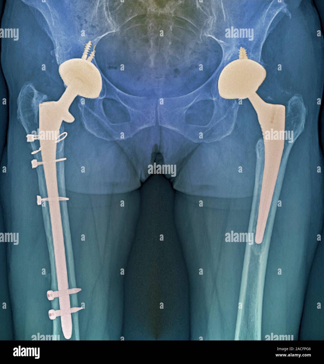 Coloured X-ray (front view) of the pelvis of a patient aged 63, showing two total hip ...
