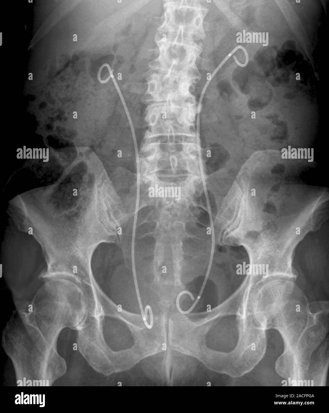 X-ray (front view) of the abdomen of a patient aged 71, showing the ...