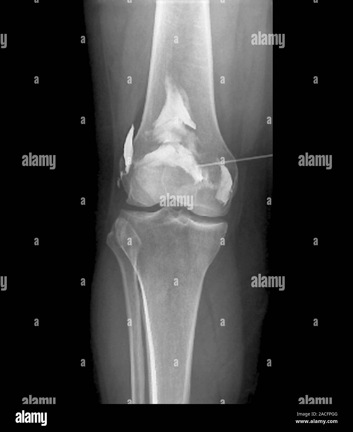 X-ray of the right knee of a patient aged 64, showing an injection ...