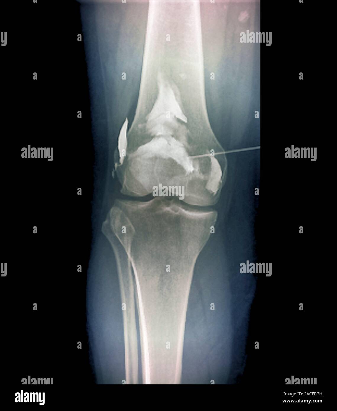 Coloured X-ray of the right knee of a patient aged 64, showing an ...