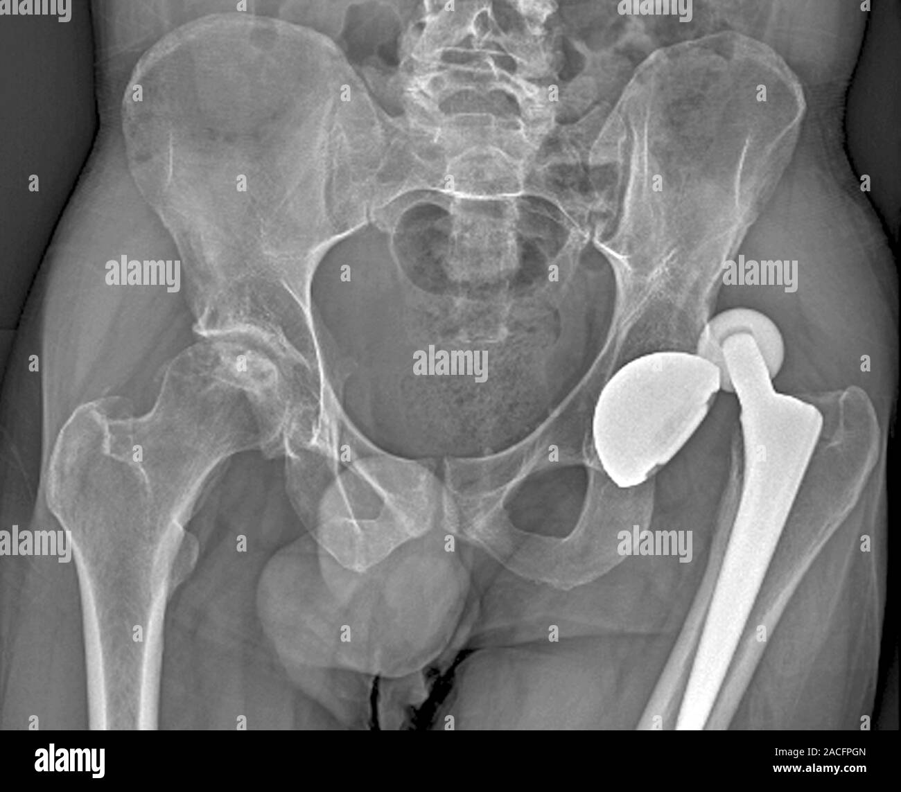 X-ray (front view, supine) of the pelvis of a patient aged 36, showing ...