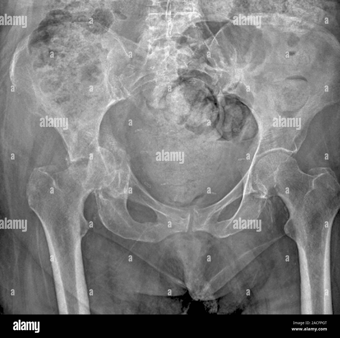 X-ray (front view, supine) of the pelvis of a patient aged 73, showing ...