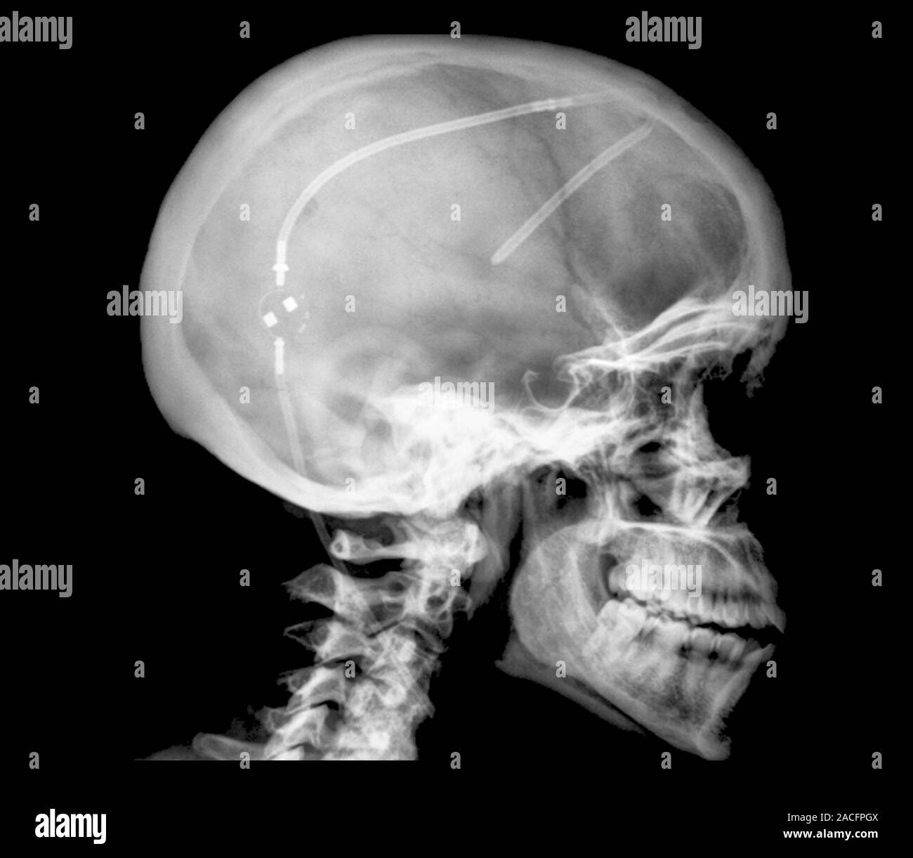 X-ray (side view) of the skull of a patient aged 55, showing the ...