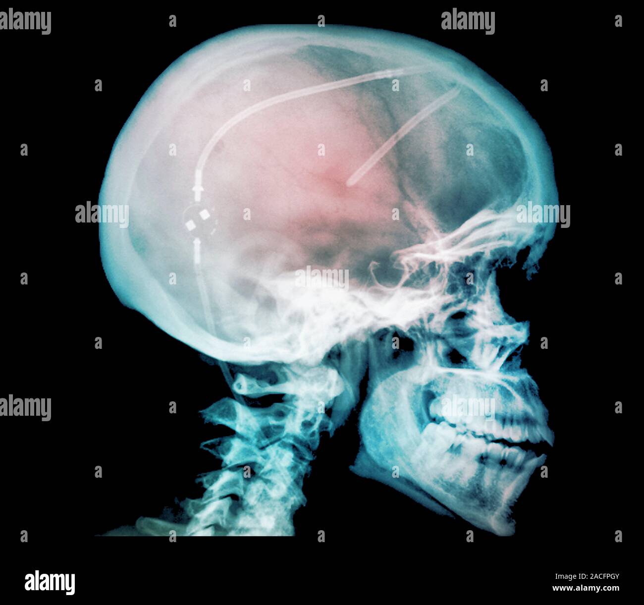Coloured X-ray (side view) of the skull of a patient aged 55, showing ...