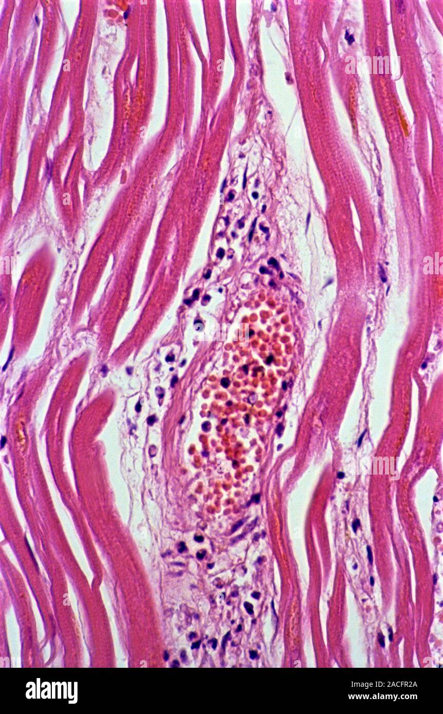 Heart tissue death. Light micrograph of a section through heart tissue ...