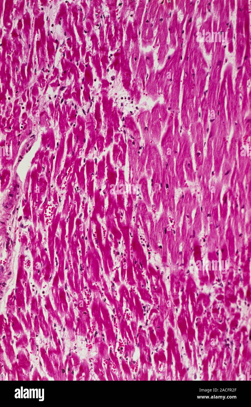 Heart tissue death. Light micrograph of a section through heart muscle ...