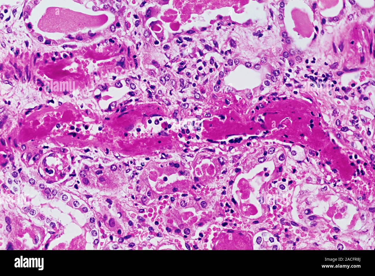 Kidney hypertension, light micrograph. Section through a kidney damaged ...